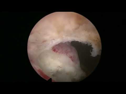 RL HoLEP, Case 39: the sixth prostate operation