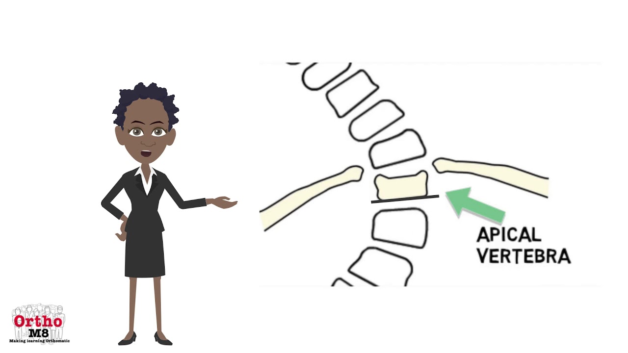 Radiographic features - RVAD