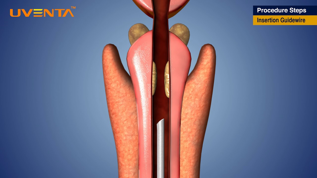 UVENTA™ Urethral Stent