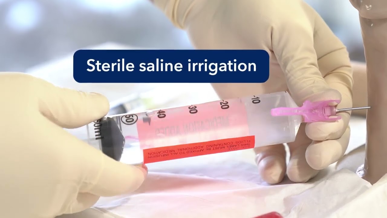 How to perform priapism aspiration