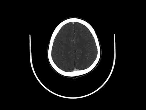 Ct scan of Head & Neck