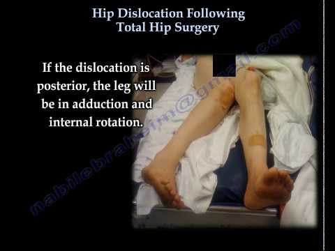 Hip Dislocation Following Total Hip replacement - Everything You Need To Know - Dr. Nabil Ebraheim