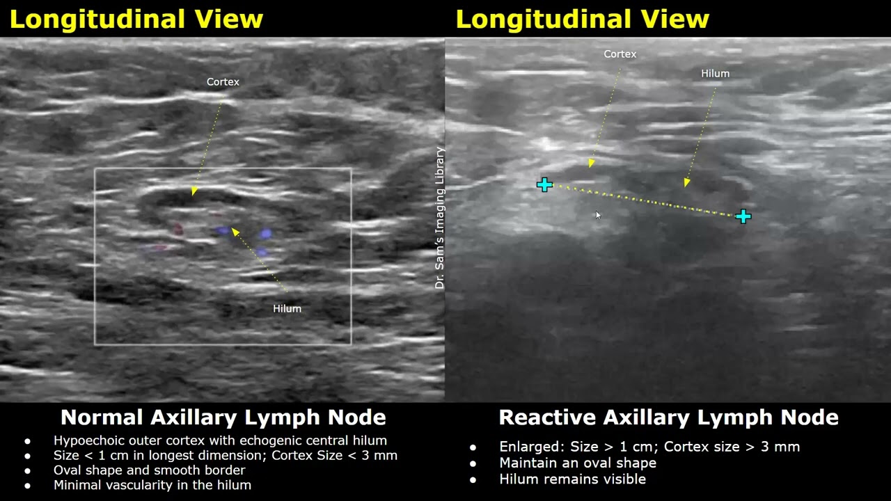 Axillary Lymph Nodes Ultrasound Normal Vs Abnormal Images With Doppler | Reactive & Malignant Nodes
