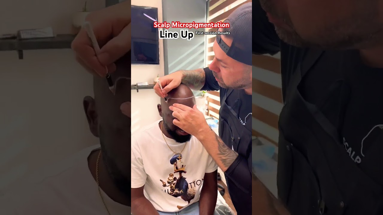 Micro Hair Tattooing #scalpmicropigmentation #smp #edmonton #hairlosstreatment