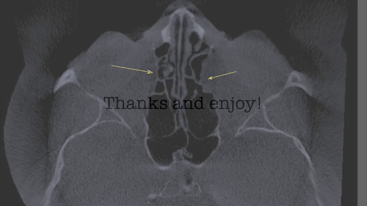 Medial displacement lamina papyracea