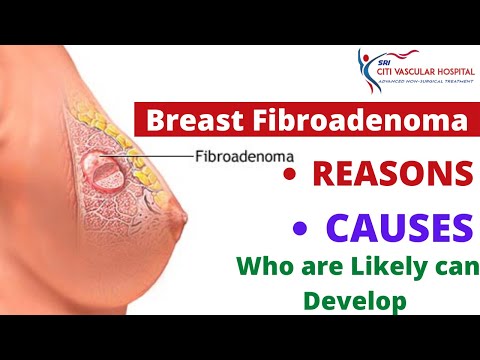 Breast Fibroadenoma : Causes and Risk Factors | Who are likely to develop benign breast lumps?