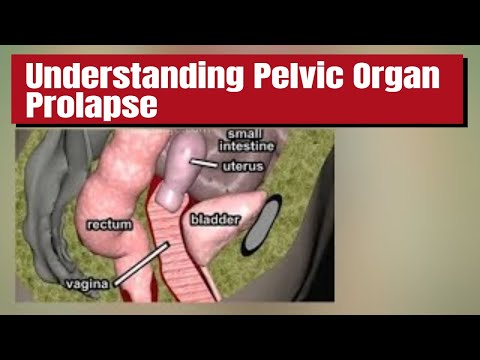 Why Your Organs Are Falling Out (Pelvic Organ Prolapse Explained)
