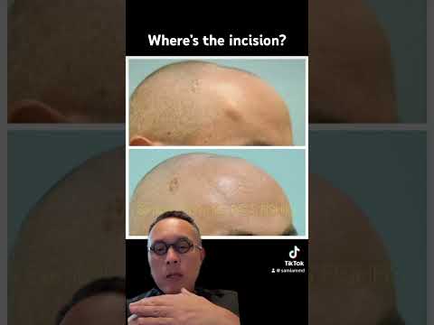 Where’s the incision?