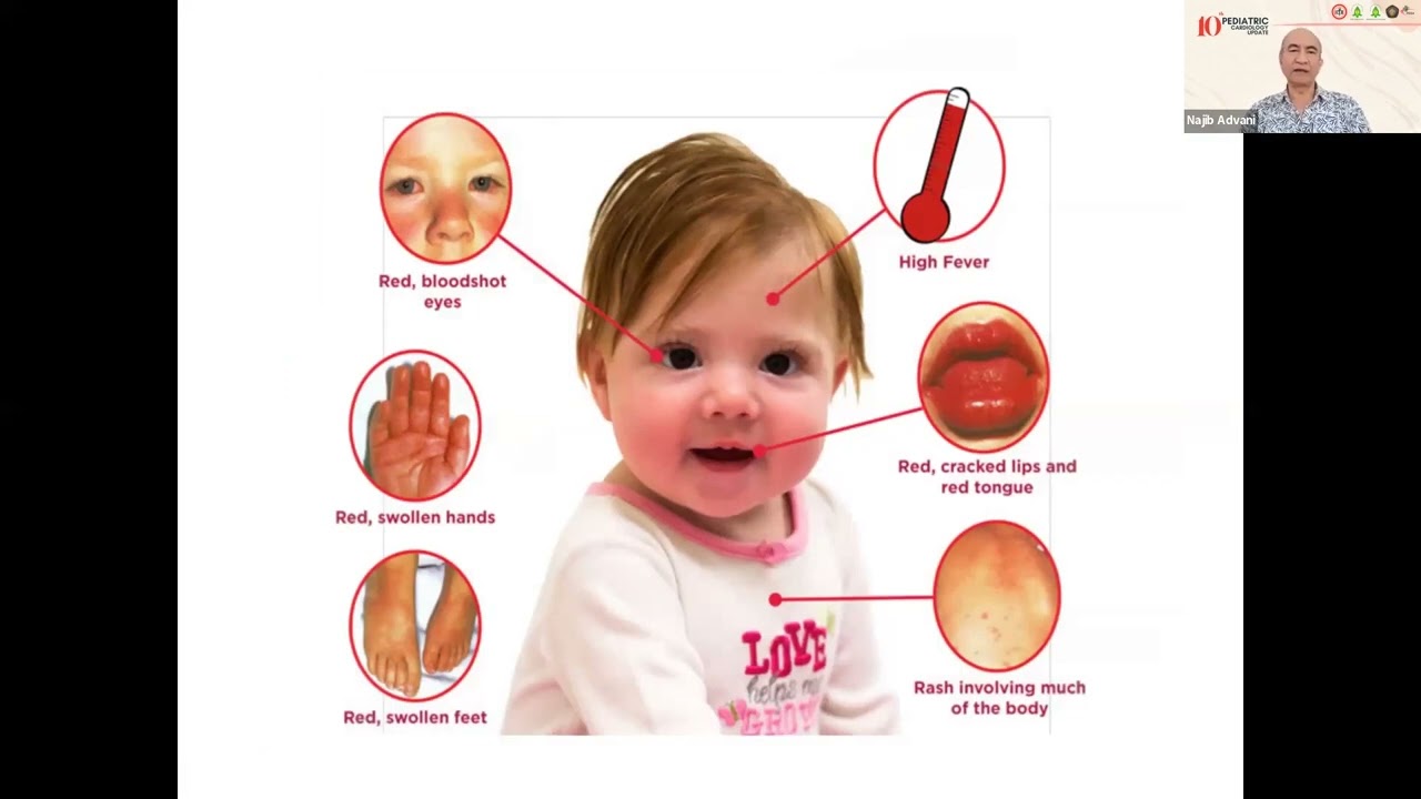 Diagnosis & Tatalaksana Terkini Penyakit Kawasaki - Prof. Dr. dr. Najib Advani, Sp.A(K),M.Med (Paed)