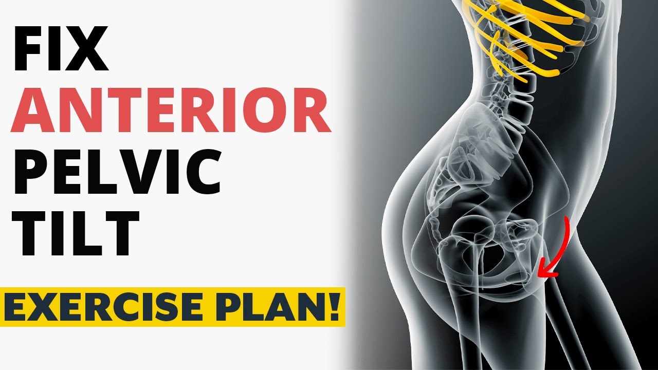 How To Fix Anterior Pelvic Tilt (FREE Exercise Plan PDF)