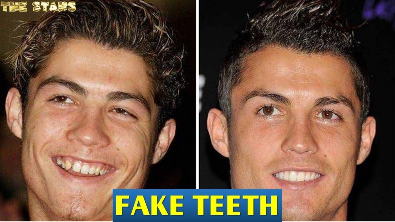 30+ Celebrities With Fake Teeth  ★2018
