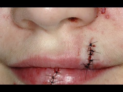 Repair of Lip laceration CPT code - simplify medical coding