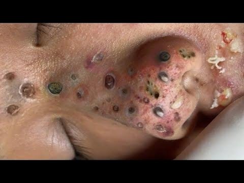 Why Do People Love Watching Pimple Popping So Much? And Here’s Why#550115