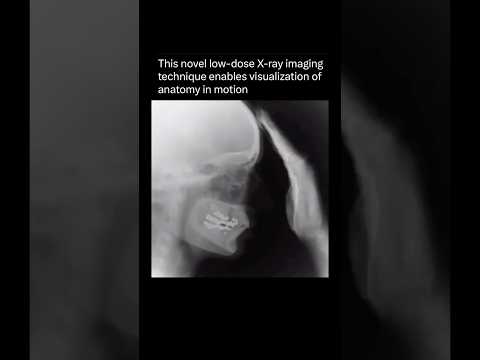 Hand & face movement seen for the FIRST-TIME with dynamic X-Ray #anatomy #radiology #medicalstudent