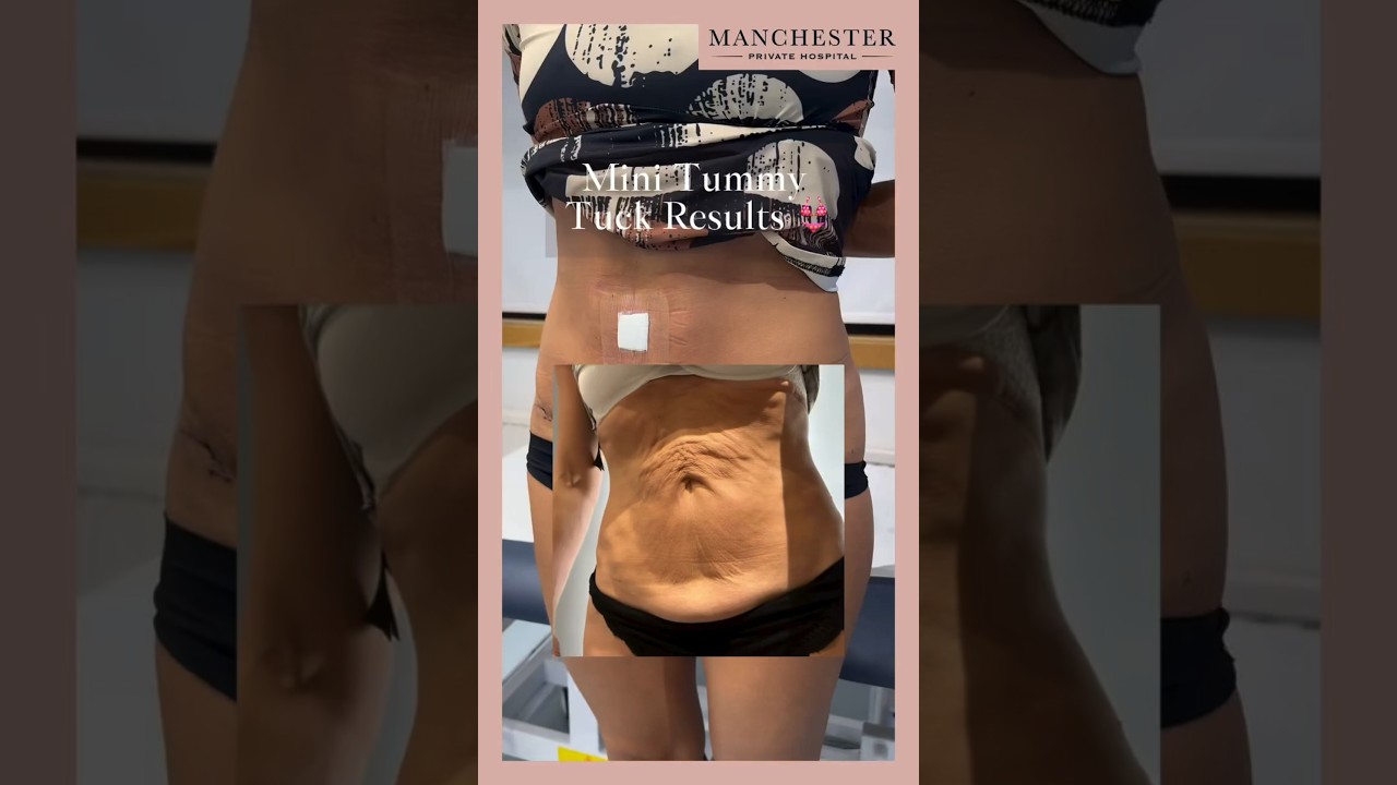 Mini Tummy Tuck Surgery Before and After | Stunning Transformation
