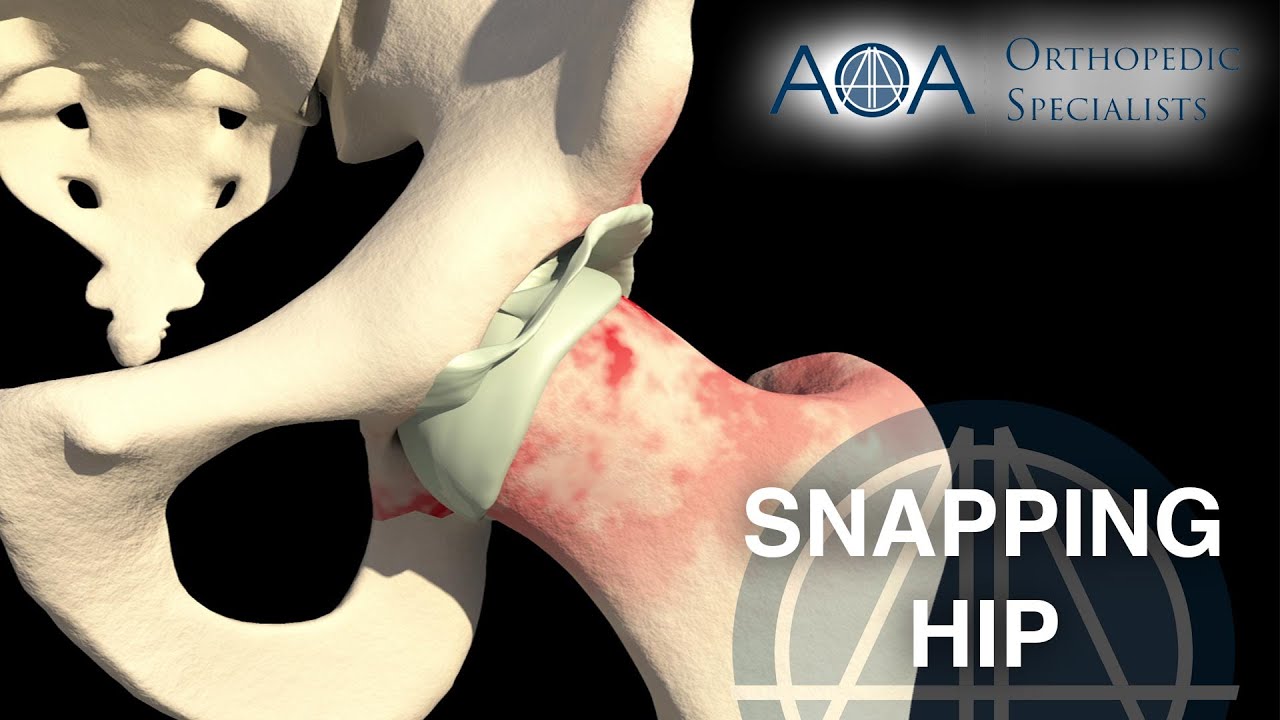AOA Orthopedic Specialists - Snapping Hip