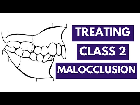 Management of Class 2 Malocclusion -Orthodontics