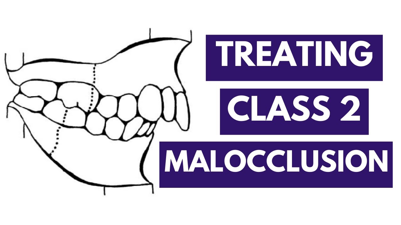 Management of Class 2 Malocclusion -Orthodontics