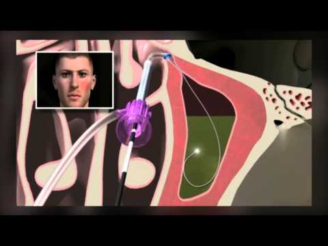 Breathe Again - Straub Ear, Nose & Throat (ENT) - Dr. John Cho