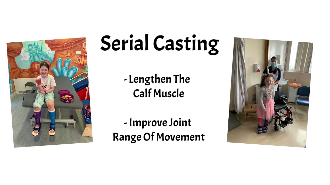 A&S Showcase | Physiotherapy led local serial casting service
