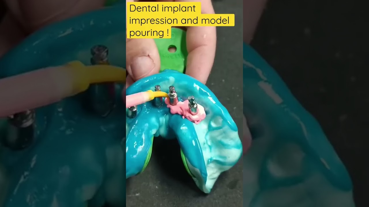 How stone Models are poured for implant  impressions? Using gum mask # dentalimplantcoursesindia