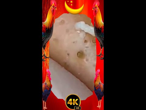 Blackheads Removal | Acne Treatment and Very Satisfying Satisfying Pimple pop #blackheads