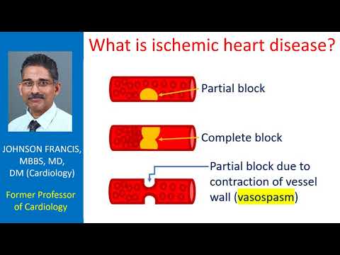 What is ischemic heart disease?