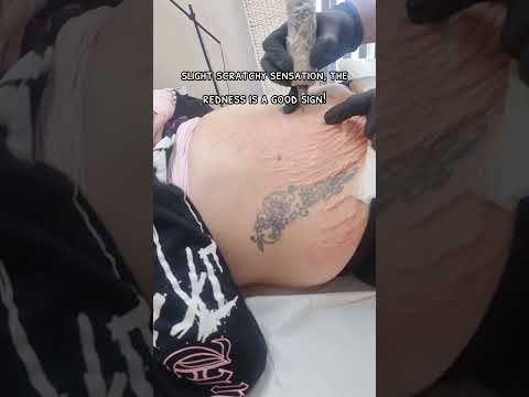 Stretch Mark Removal Process Using Inkless Camouflage (Dry Needling) Technique. How To Remove Scars