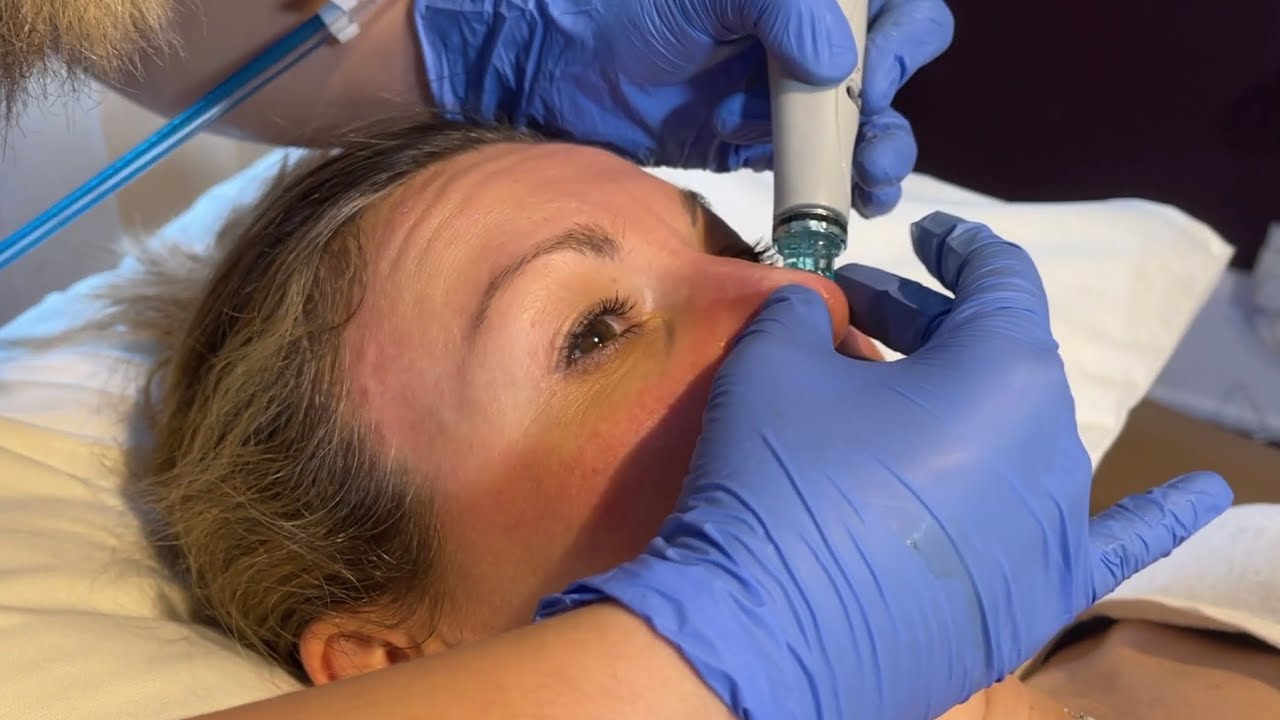 HydraFacial review: See the treatment + results up close!