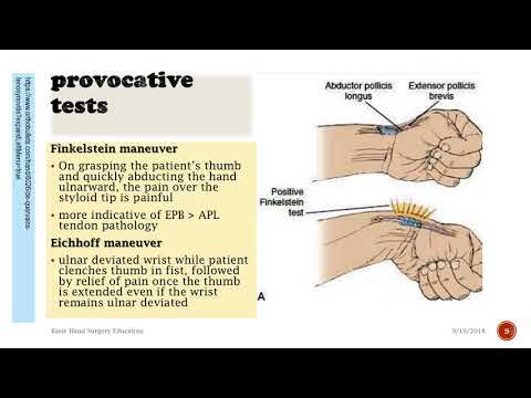 De Quervain's Tenosynovitis - Hand - Orthobullets