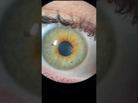 Pupil Dilation | DilataΓ§Γ£o pupilar