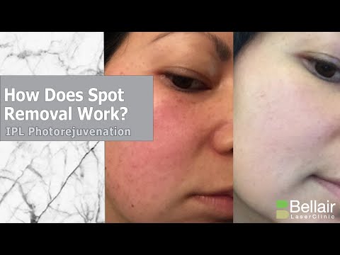 How does IPL photorejuvenation work?