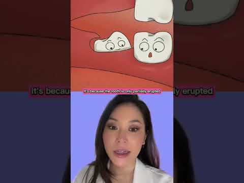 Bad Breath from a Wisdom Tooth #badbreath