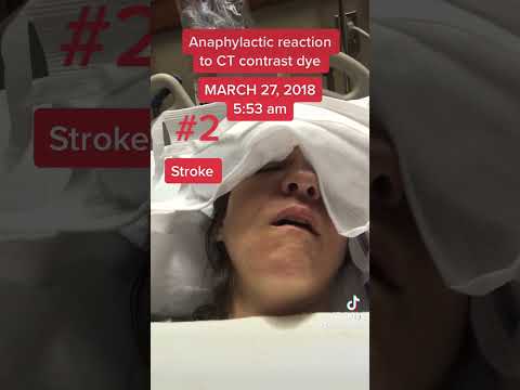 Stroke: Anaphylaxis to CT contrast dye