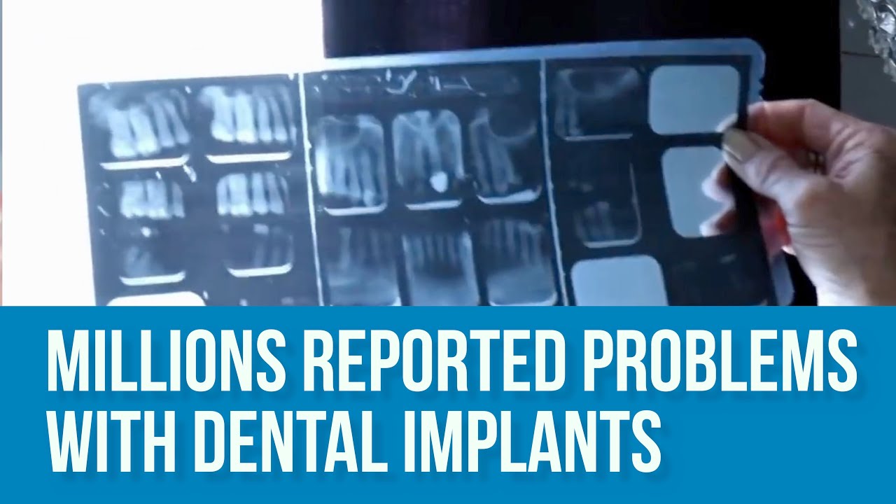 Dental Implants Expert Debunks Wild Claims - 