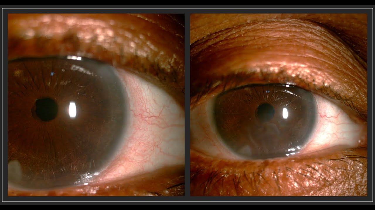 The Retained nucleus fragment in the anterior chamber