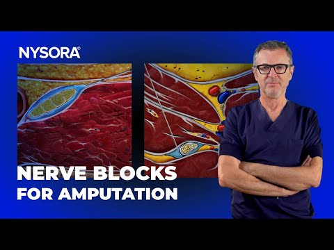 Sciatic + Femoral Nerve Blocks for AKA Amputation (Nysora) – POCUS Academy