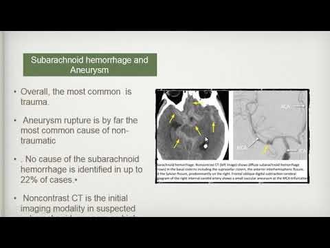 Cerebral vascular malformation