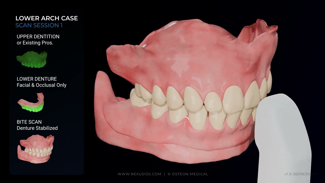 Nexus iOS - Definitive Protocol from Denture - Lower Arch