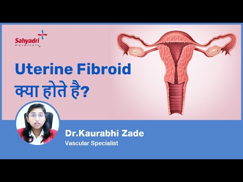 Uterine Fibroid क्या होते है? | Treatment for Uterine Fibroids in Hindi | Dr Kaurabhi Zade, Sahyadri