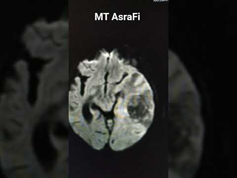 Brain study Of MRI ll #brain #mri #mtasrafi #anatomy #shortvideo