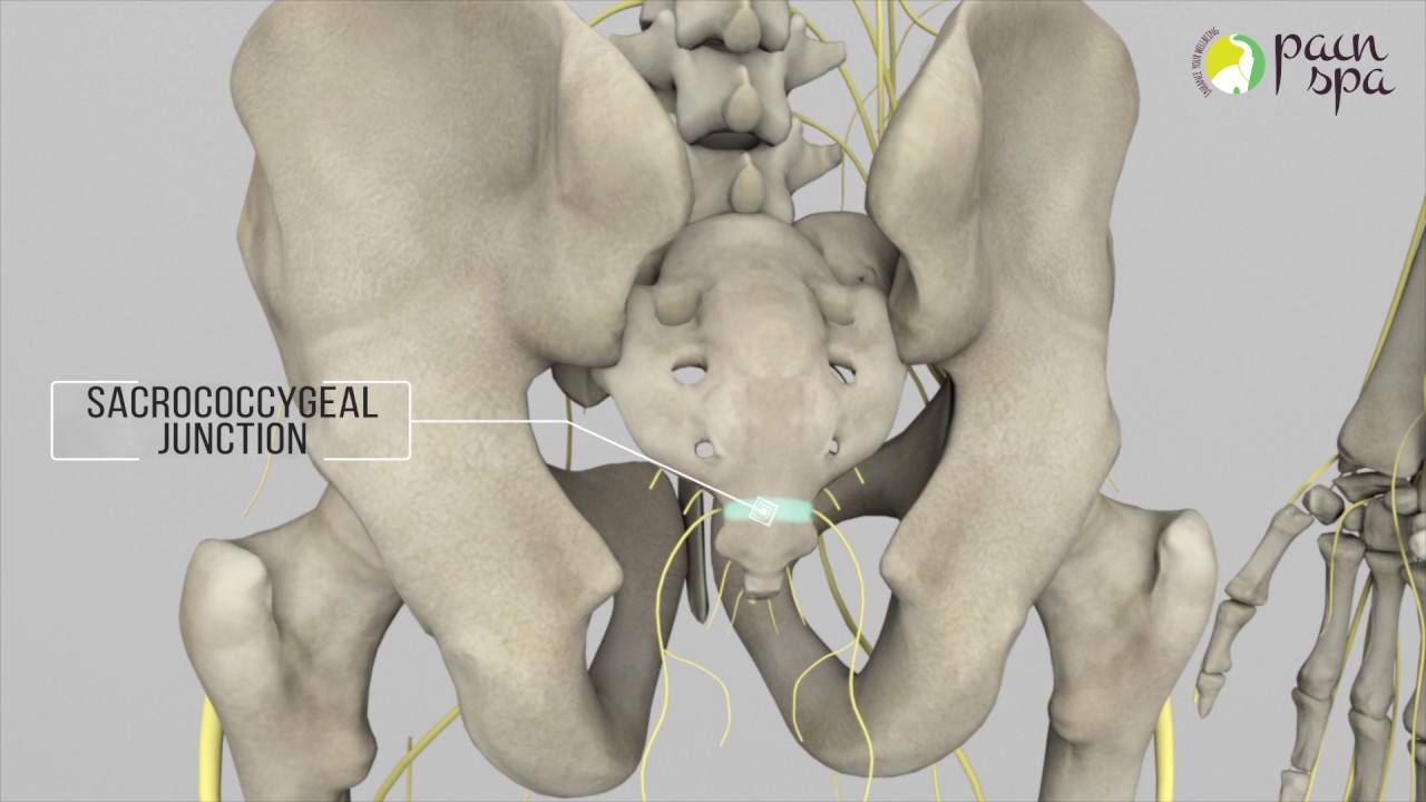Coccyx Pain & Ganglion Impar Block
