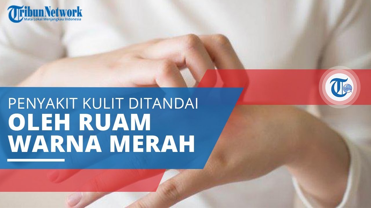 Kurap, Penyakit Kulit yang Ditandai dengan Munculnya Ruam Bulat ...