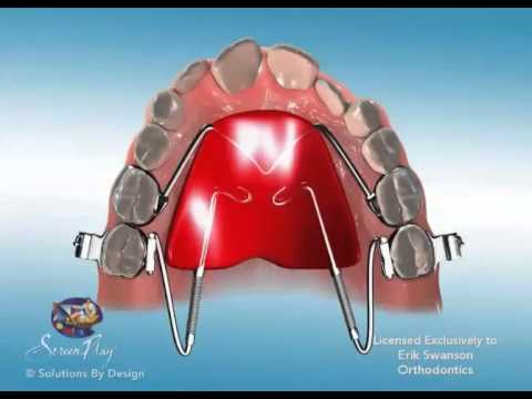 Distal Jet Appliance.wmv Video Lecture - Dental