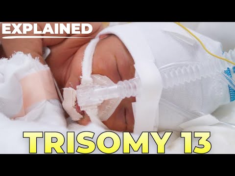 TRISOMY 13: A Comprehensive Guide (The Parents, The Children, The Statistics & Medicine)