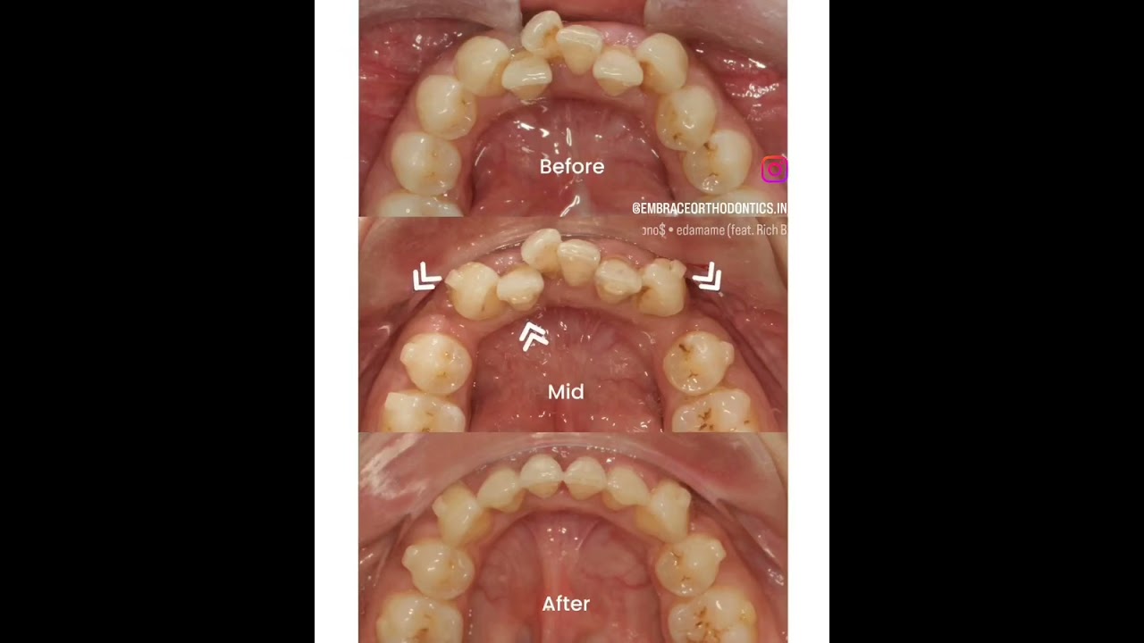 Alignment of crooked teeth with Invisalign. Premolar Extraction Treatment.