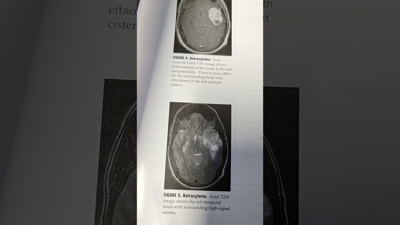 MRI of Astrocytoma | Brain tumor | Imaging