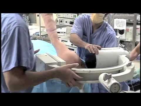 Arthroscopic Management of Os Acromiale