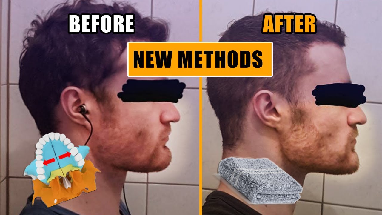 Exploring the Effectiveness of Thumb Pulling and the Towel Method in ...