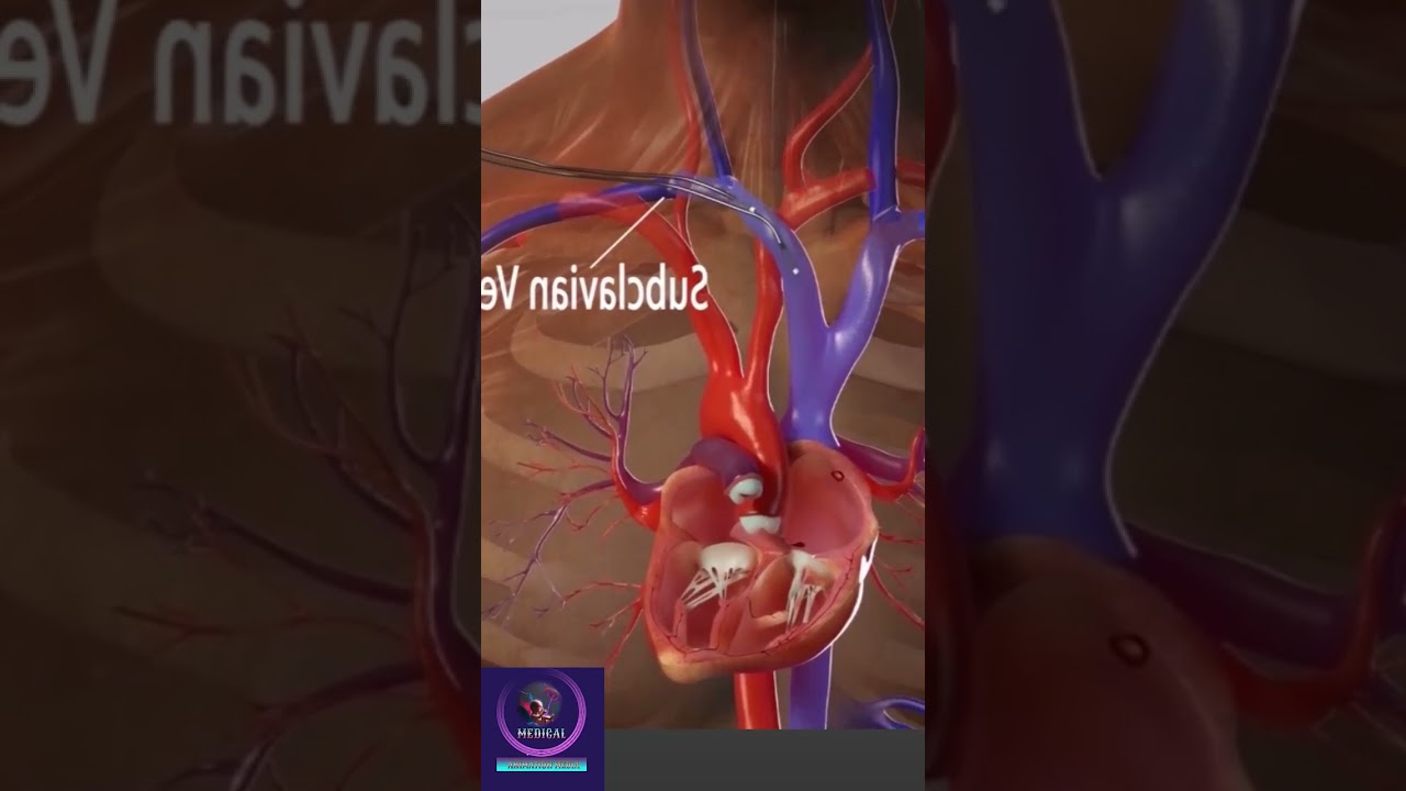 Pacemaker Insertion Procedure - Cardiac Treatment